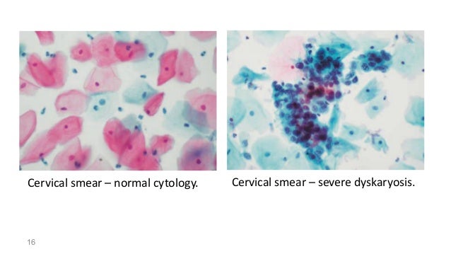 Cervical cancer
