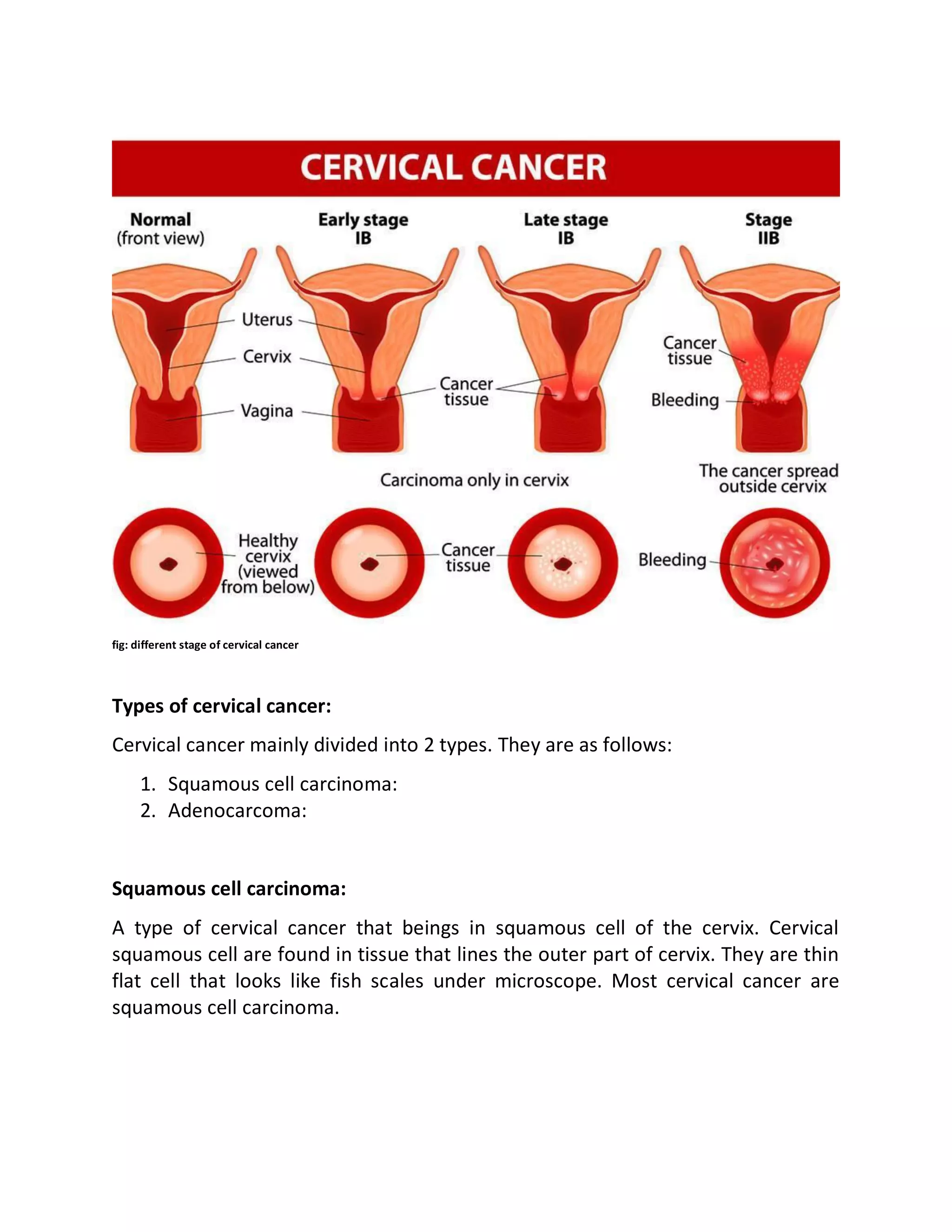 Cervical cancer | PDF