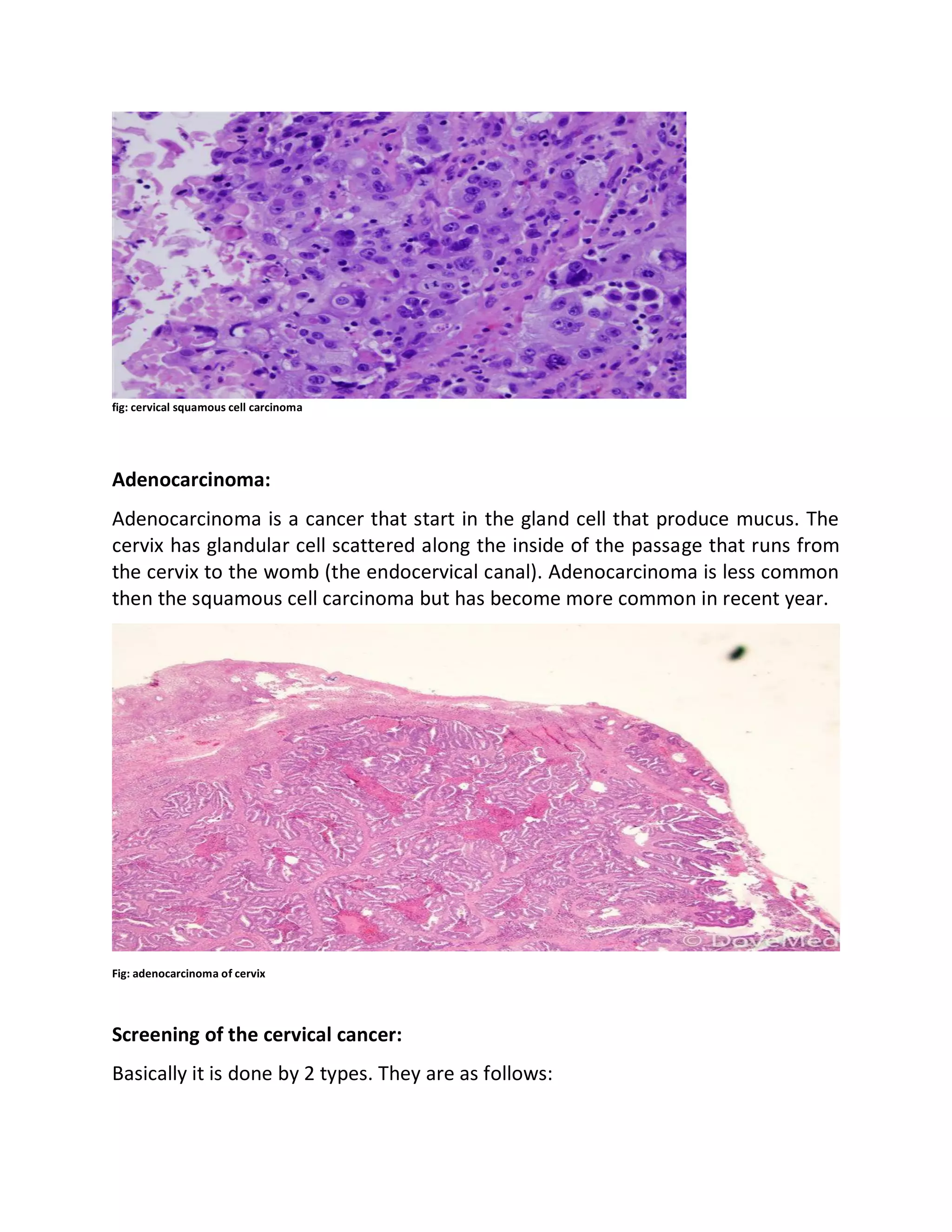 Cervical cancer | PDF