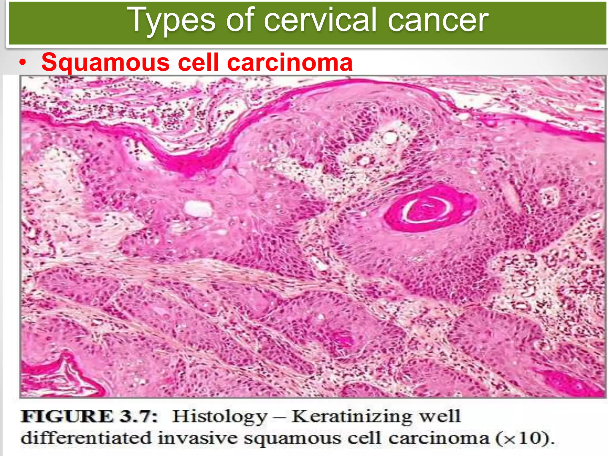 Cervical cancer | PPTX