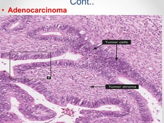 Cervical cancer | PPTX