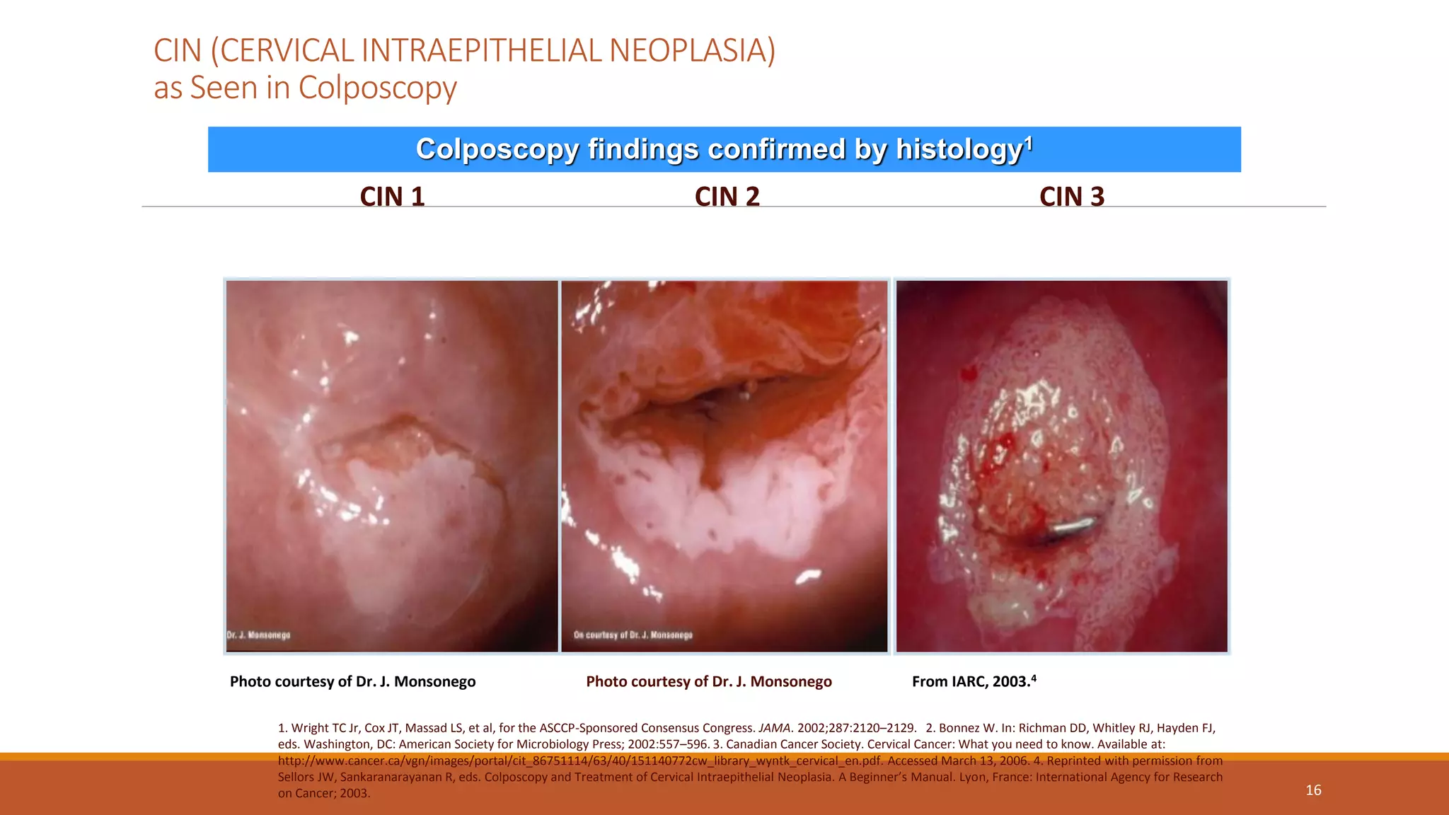 Cervical cancer | PDF