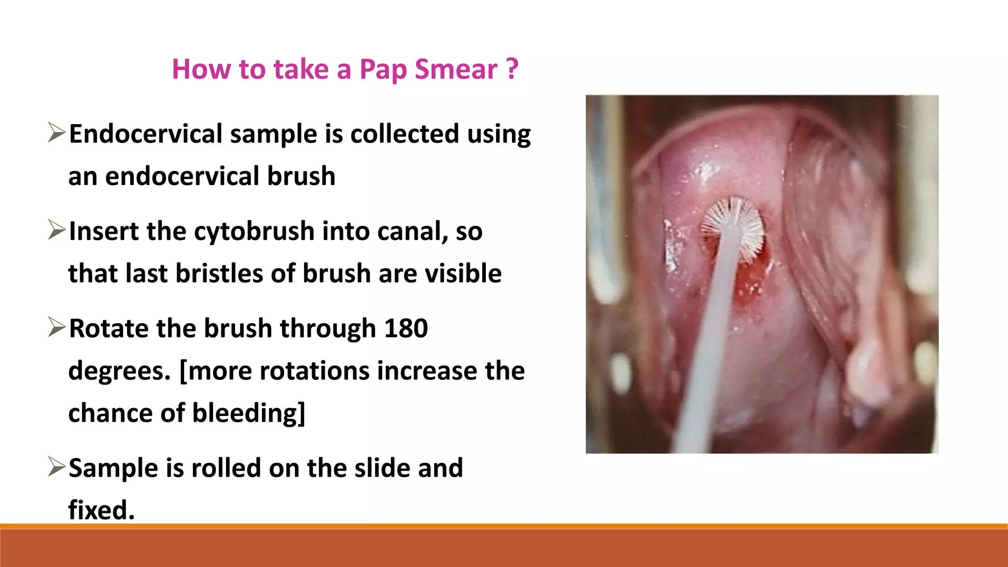 Cervical cancer | PDF