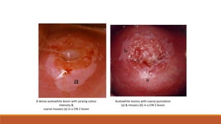 Cervical cancer | PDF