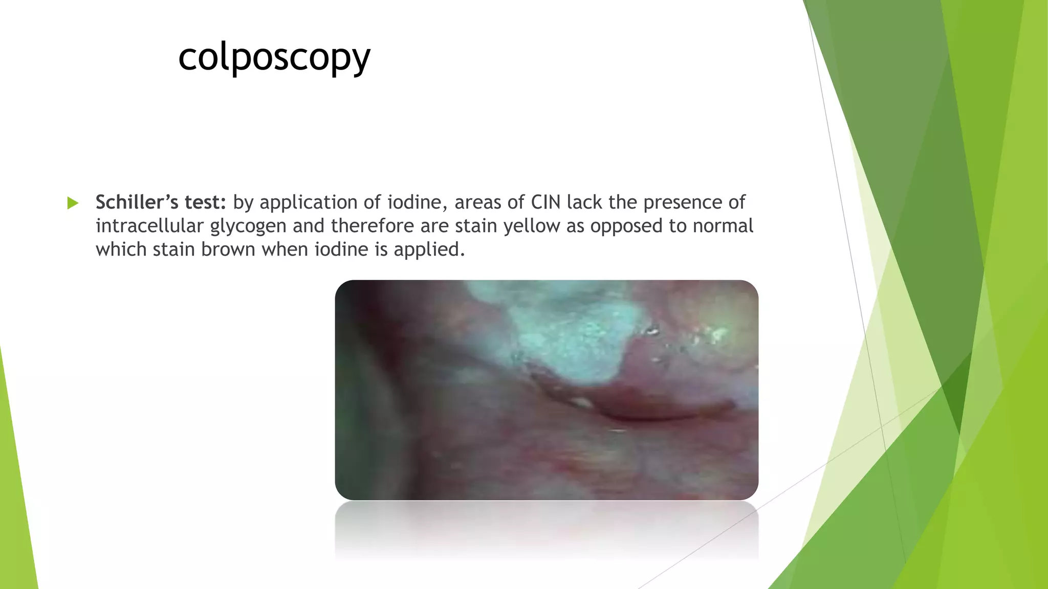 Cervical cancer | PPTX