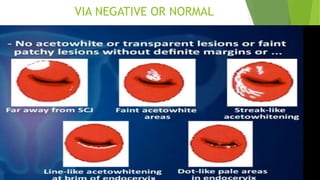 Cervical cancer | PPTX