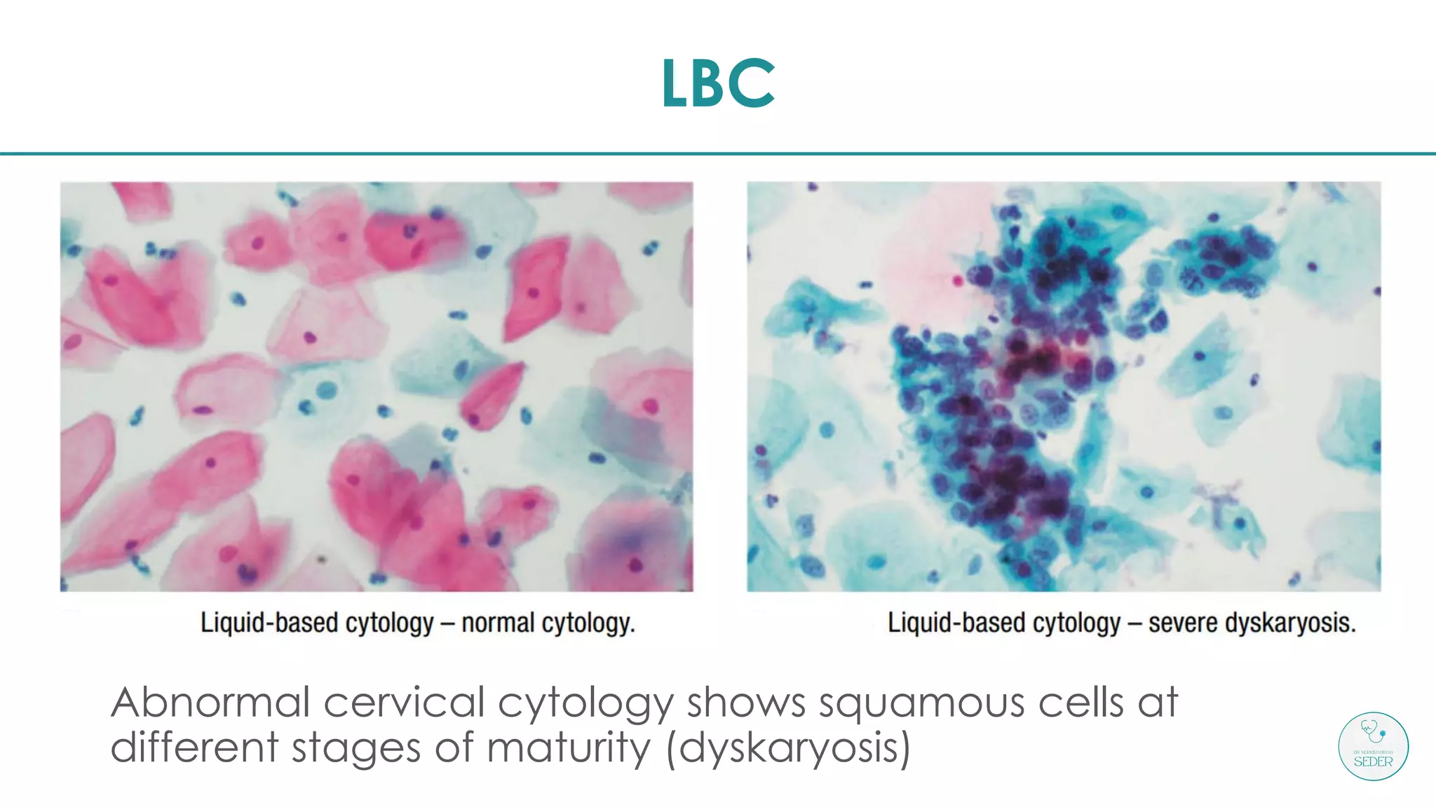 CERVICAL CANCER | PDF