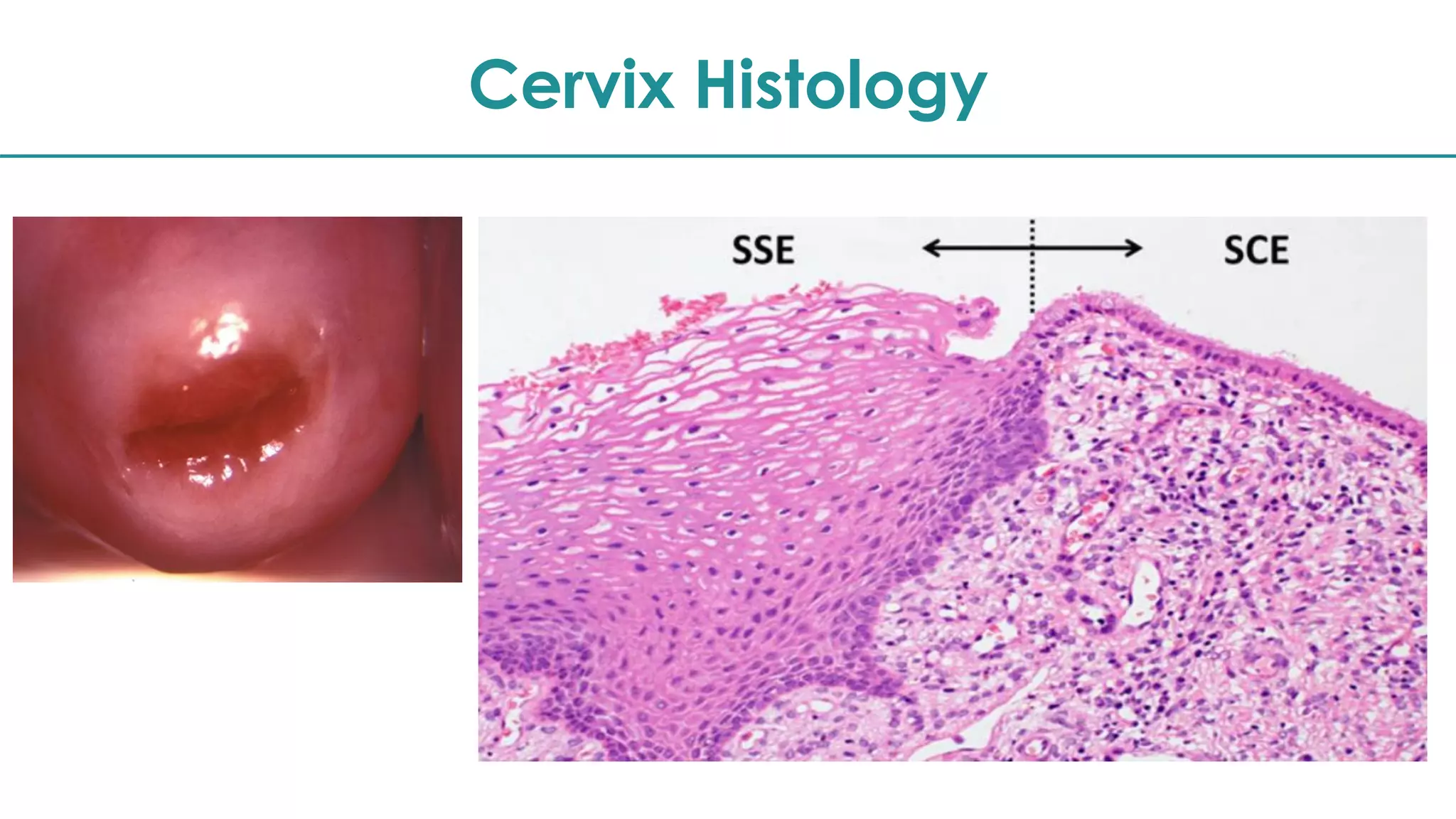 CERVICAL CANCER | PDF