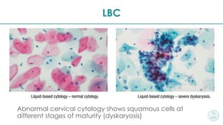 CERVICAL CANCER | PDF