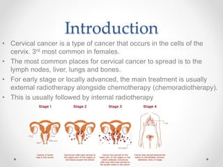 Cervical Cancer | PPT
