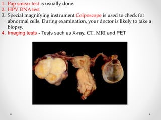 Cervical Cancer | PPTX