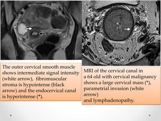 Cervical Cancer | PPT
