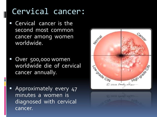 cervical cancer.pptx