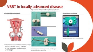 cervical cancer lecture- management and staging | PPTX