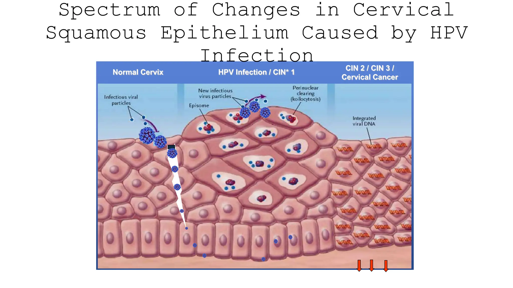 Recent advances on Cervical cancer .pptx