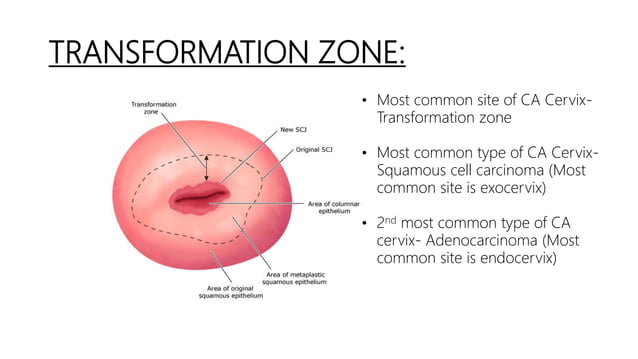 CERVICAL CANCER (CIN).pptx