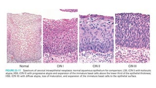 Cervical cancer presentation at CDH ZAMBIA | PPTX