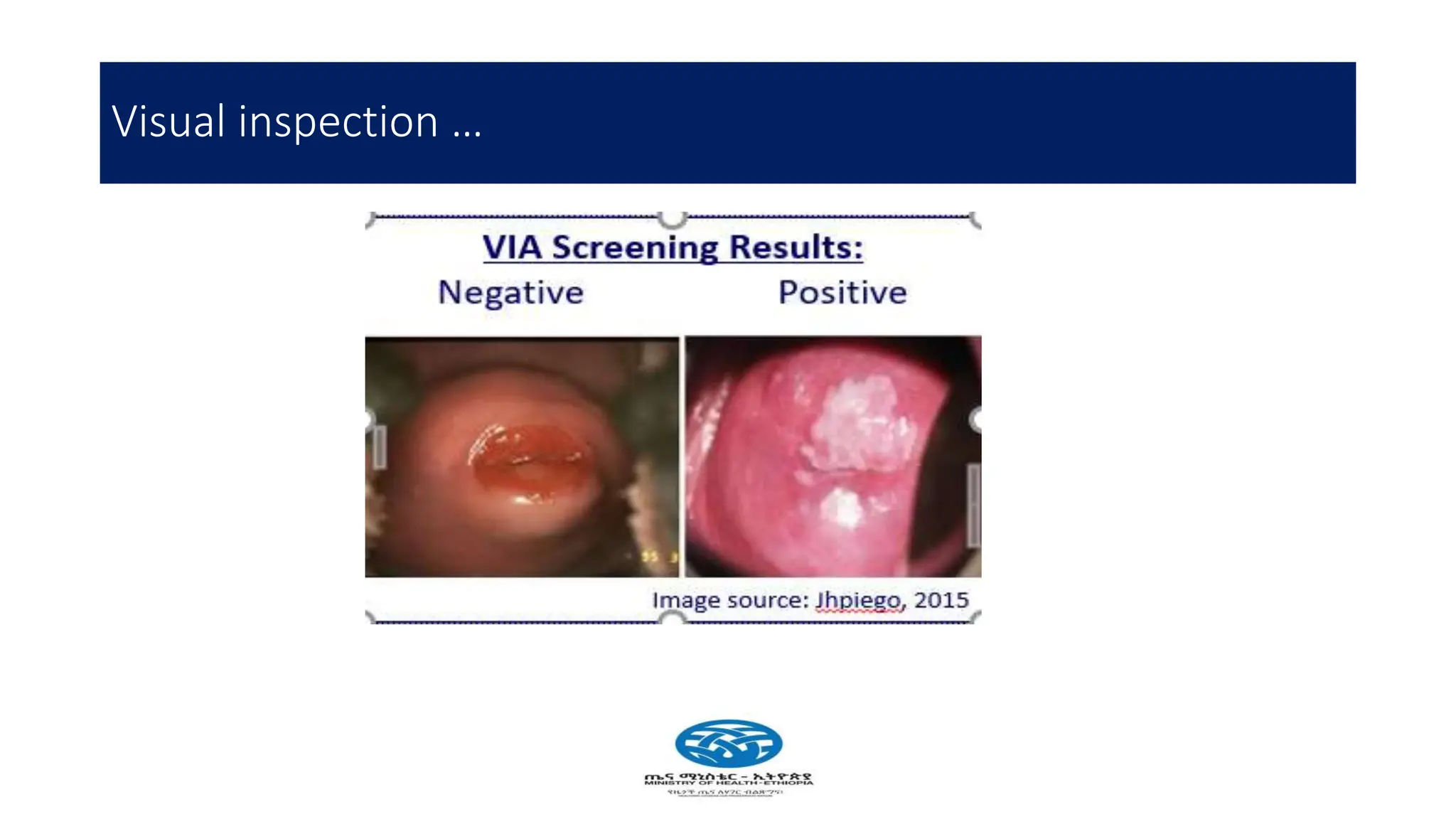 Cervical Cancer Prevention Updates Pptx