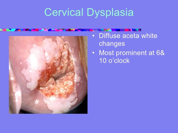 Shoulder to Shoulder: Cervical Cancer Screening
