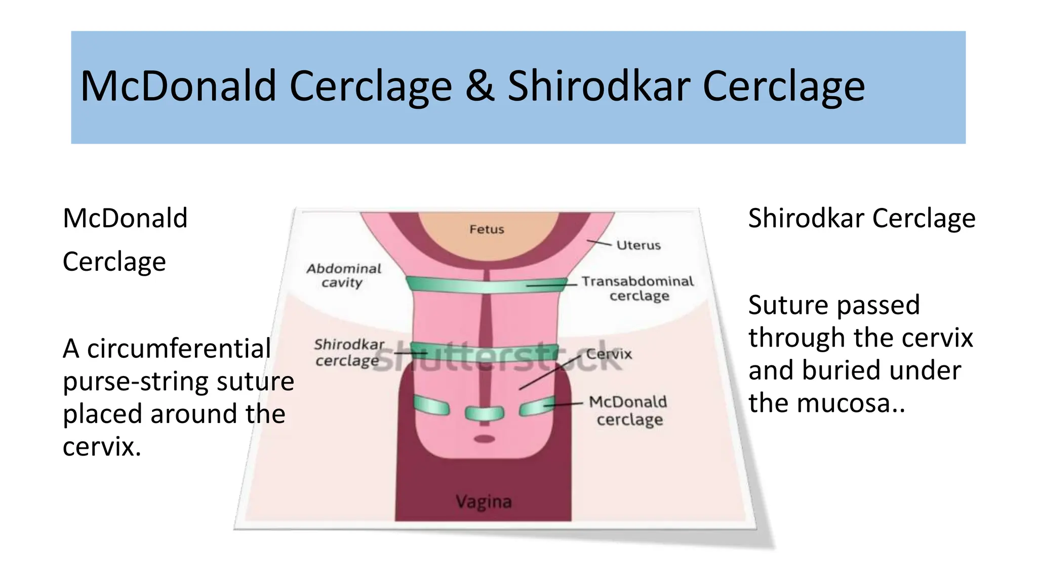 Cervical Cercalage Guidelines, it's types, indications and ...
