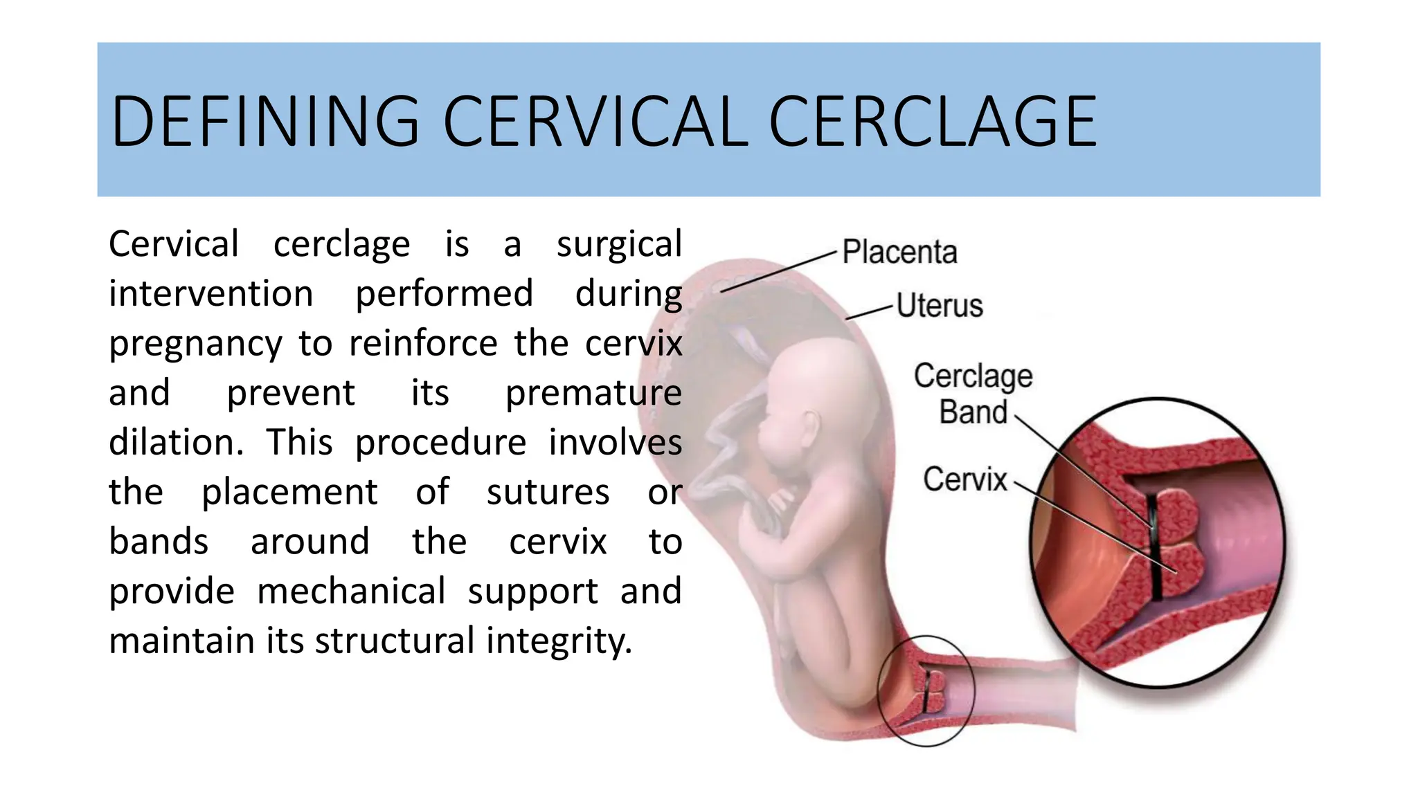 Cervical Cercalage Guidelines, it's types, indications and contraindications | PPTX