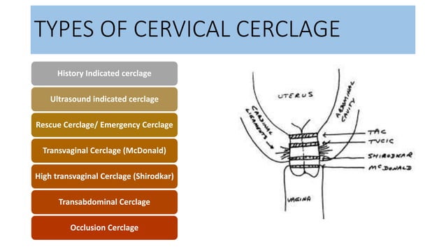 Cervical Cercalage Guidelines, it's types, indications and ...