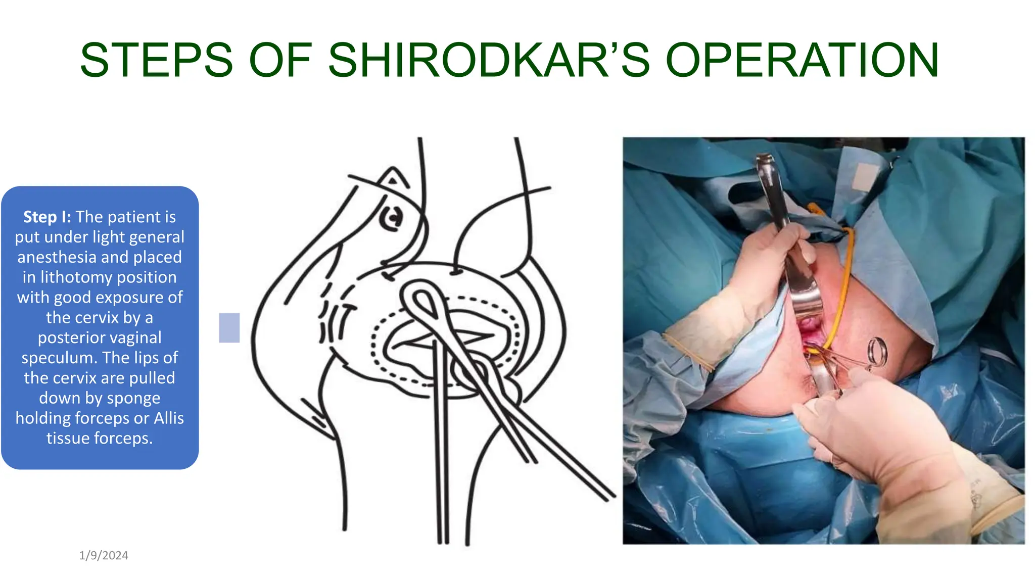 cervical cerclage.pptx
