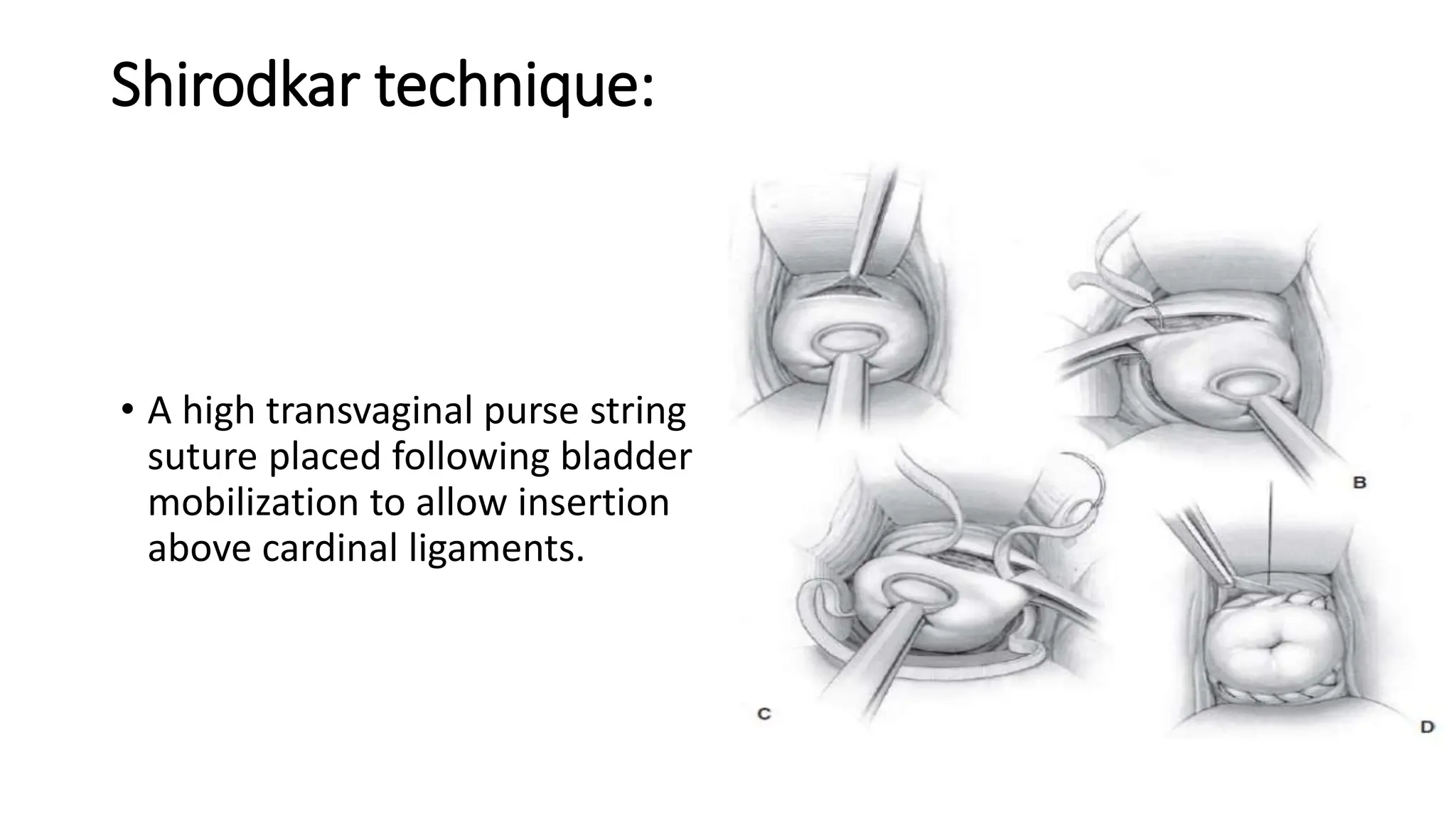 cervical cerclage.pptx