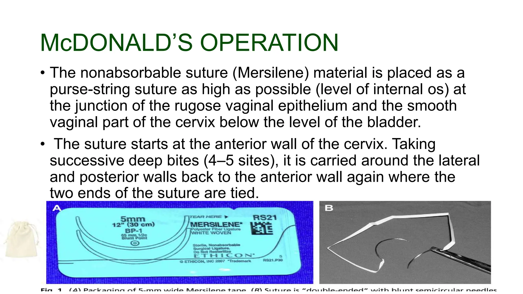 cervical cerclage.pptx