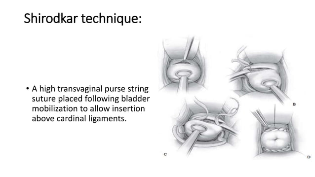 cervical cerclage.pptx | Pregnancy | Reproductive Health