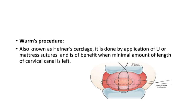 cervical cerclage.pptx | Pregnancy | Reproductive Health
