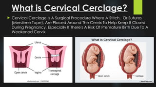 This is a presentation on CERVICAL CERCLAGE | PPTX
