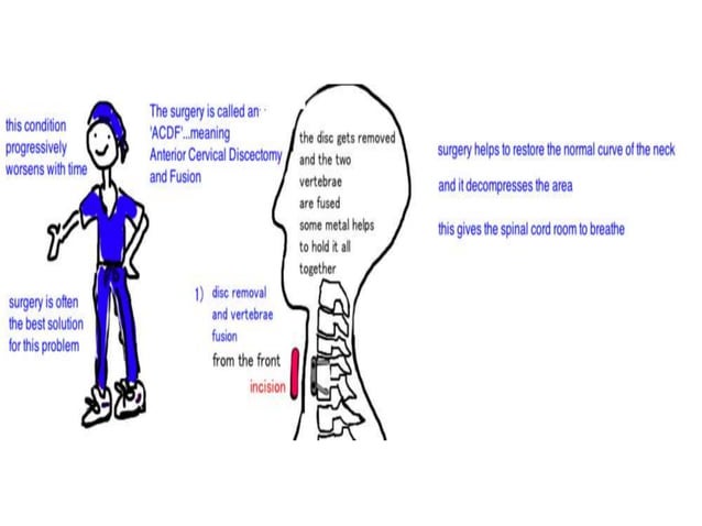 Cervical cord compression | PPT