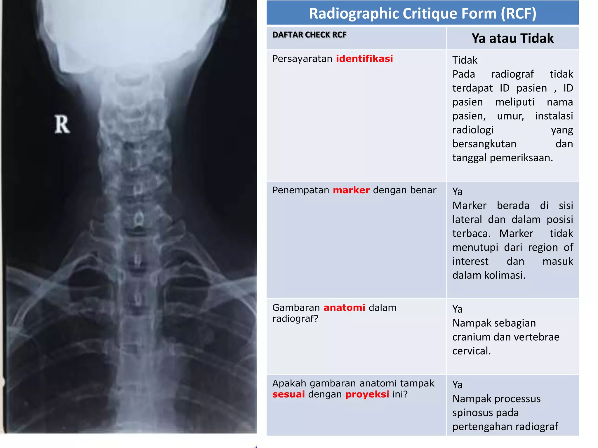 ppt kritisi dan evaluasi radiograf Cervical dan thoracal | PPTX