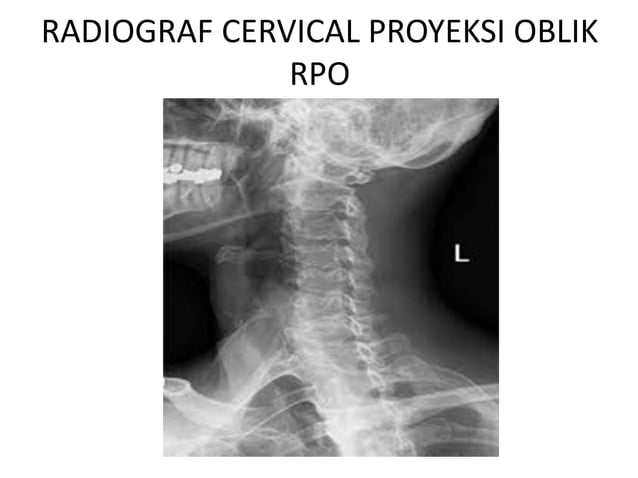 ppt kritisi dan evaluasi radiograf Cervical dan thoracal | PPTX