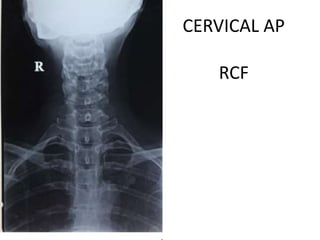 ppt kritisi dan evaluasi radiograf Cervical dan thoracal | PPTX
