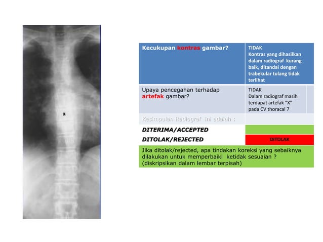 ppt kritisi dan evaluasi radiograf Cervical dan thoracal | PPTX