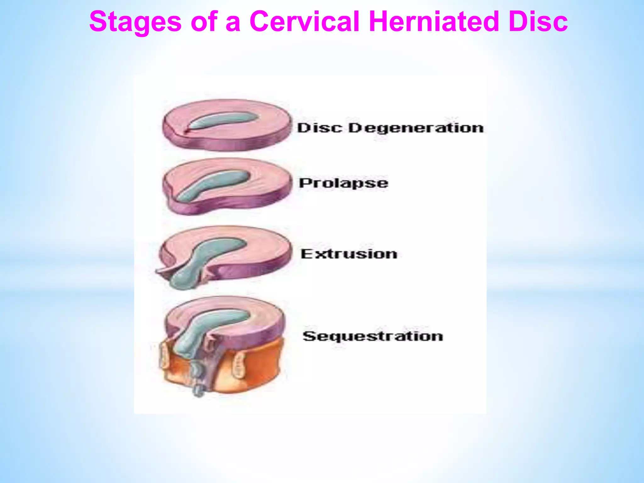 Cervical disc herination.pptx