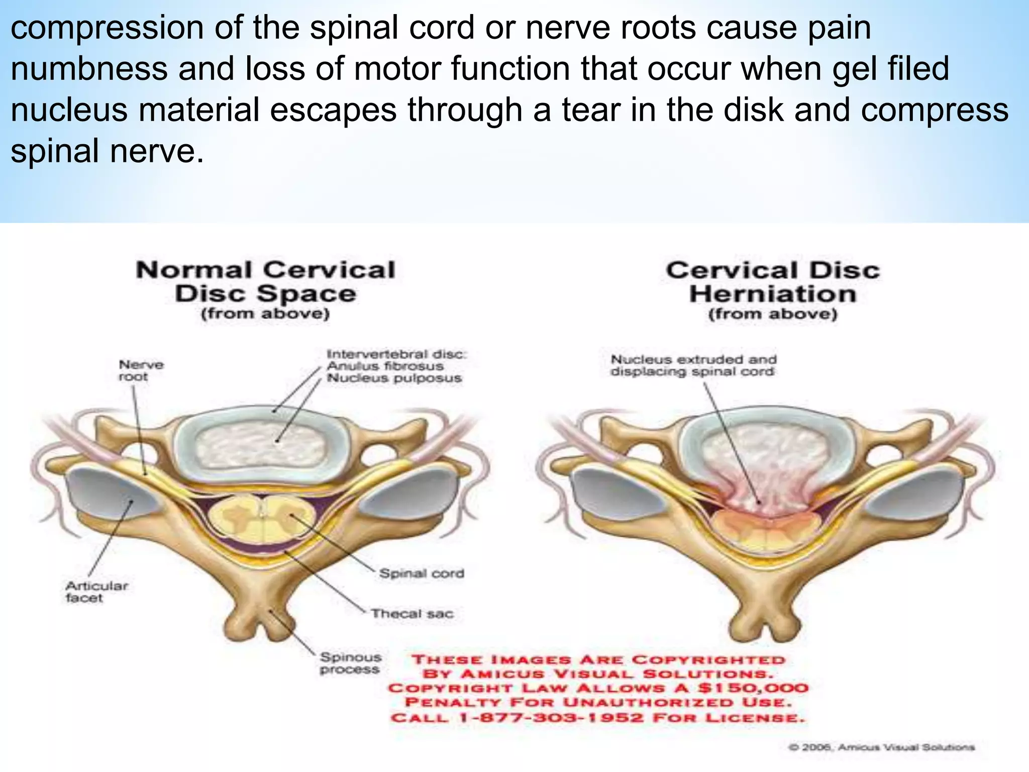 Cervical disc herination.pptx