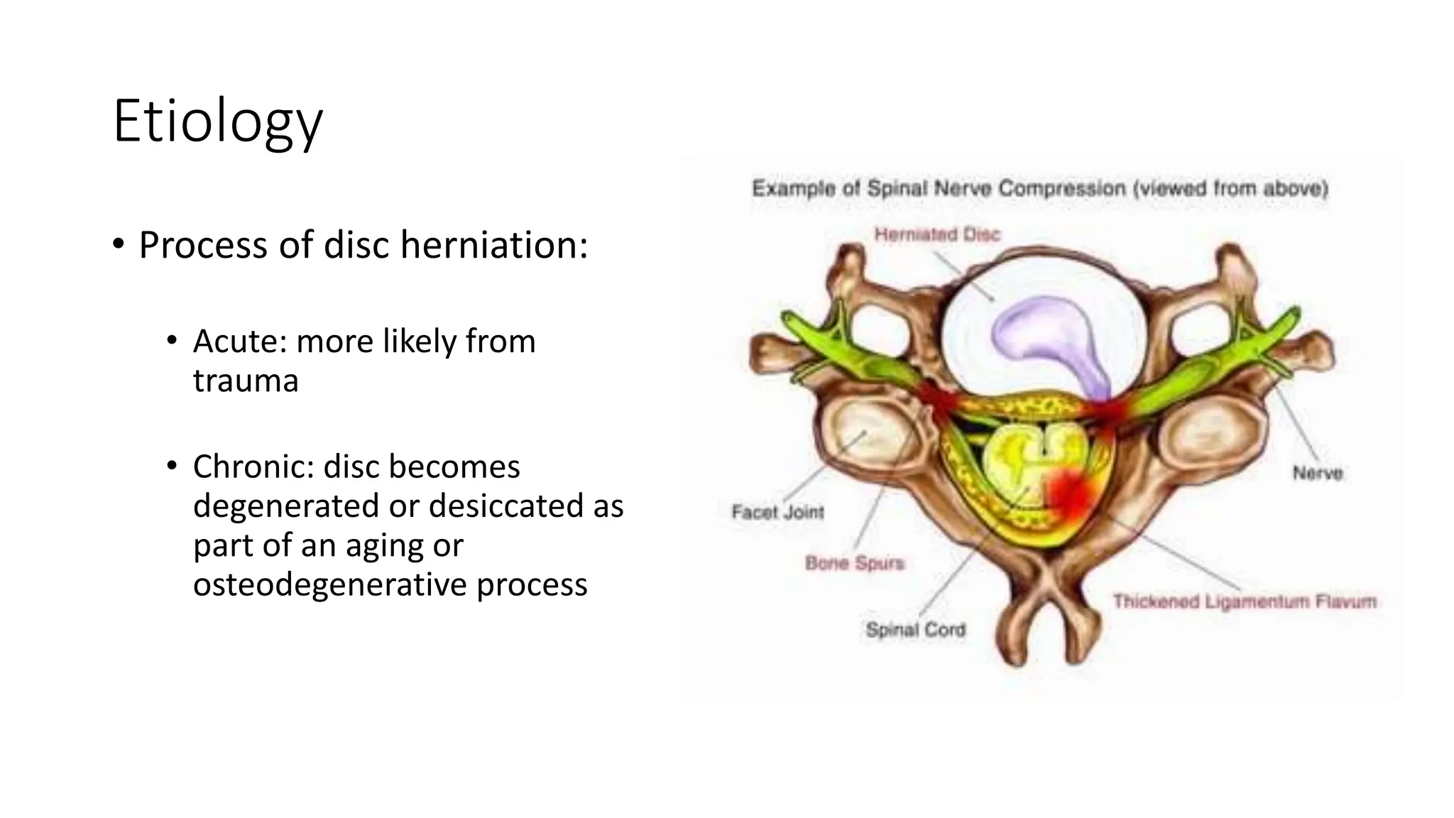 Overview of Cervical Disc Herniation.pptx