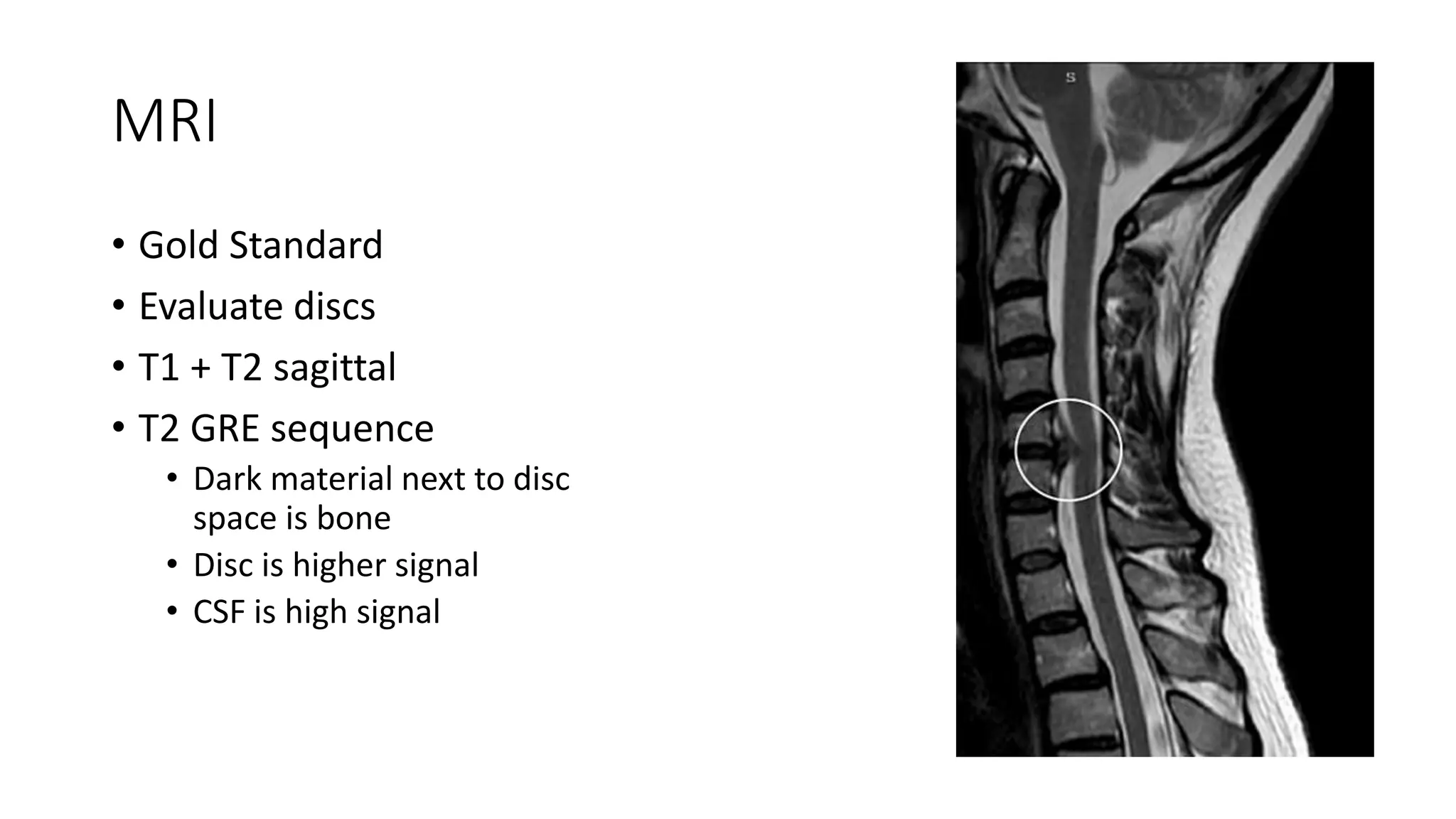 Overview of Cervical Disc Herniation.pptx