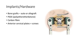 Overview of Cervical Disc Herniation.pptx