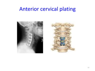 Cervical Disc Herniation, from A to Z mad simple | PDF