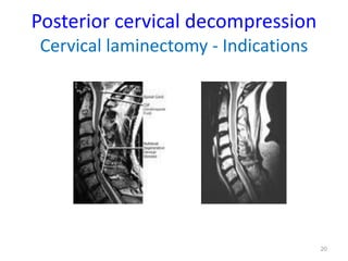 Cervical Disc Herniation, from A to Z mad simple | PDF
