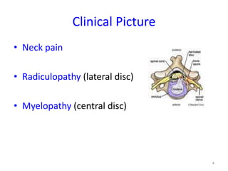 Cervical Disc Herniation, from A to Z mad simple | PDF