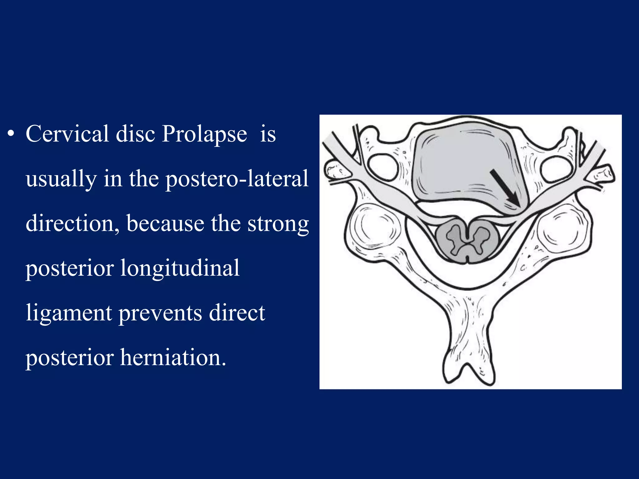 Cervical disc prolapse | PPTX