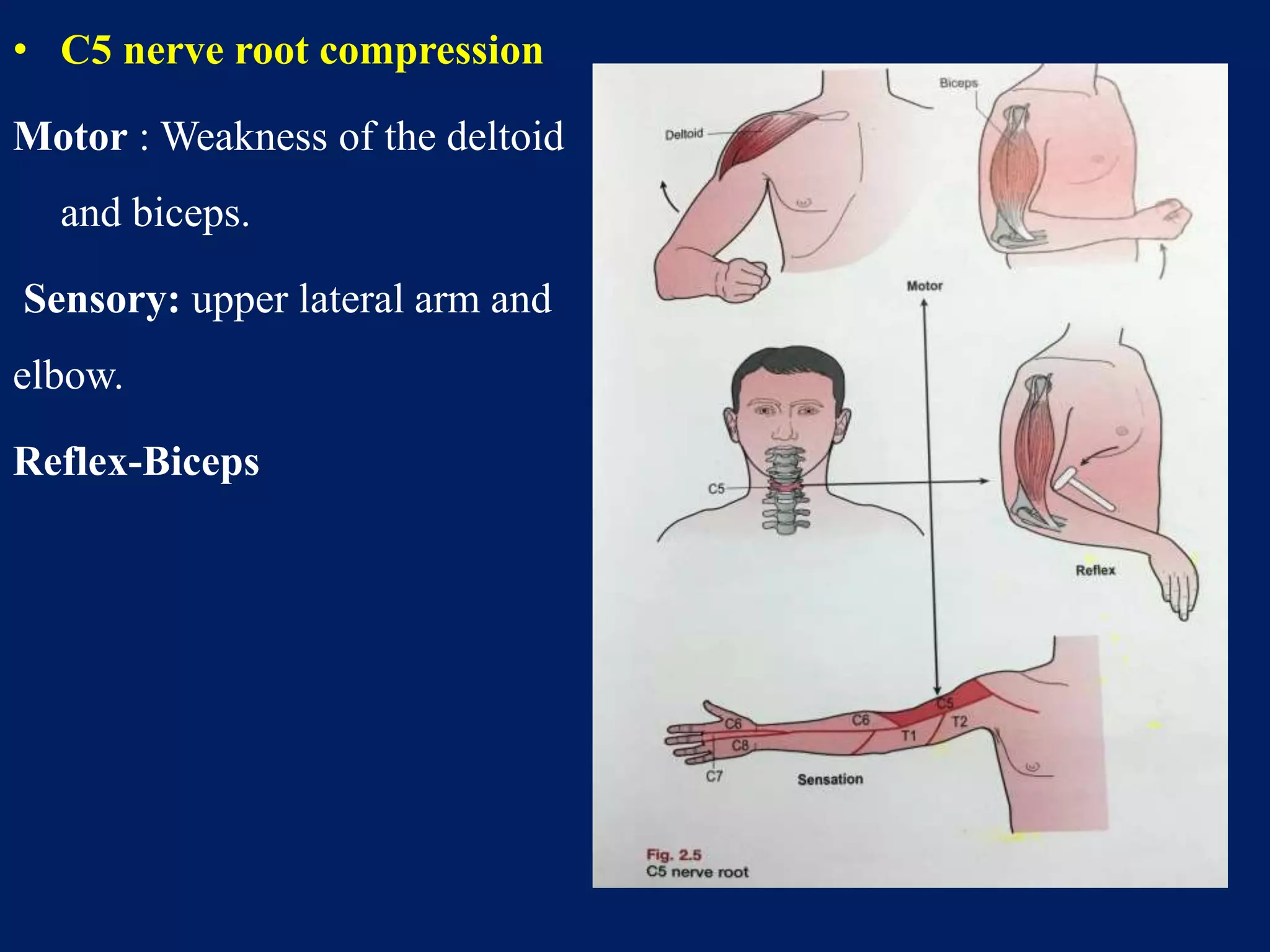 Cervical disc prolapse | PPTX