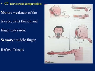 Cervical disc prolapse | PPTX