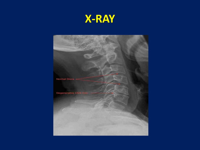 Cervical disc prolapse