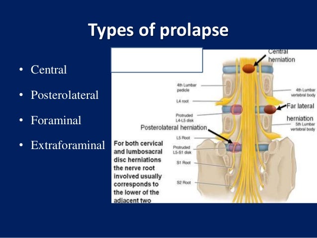 Cervical disc prolapse